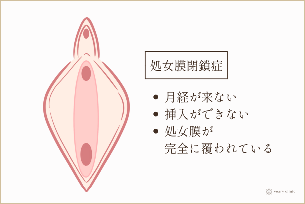 処女膜切開とは?処女膜閉鎖症・強靭症の病状や治療方法について コラム一覧| 東京の婦人科形成・小陰唇縮小・婦人科形成(女性器形成)・包茎手術・膣ヒアルロン酸クリニック